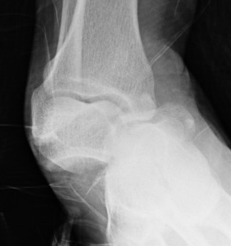 Subtalar Dislocation | The Bone School